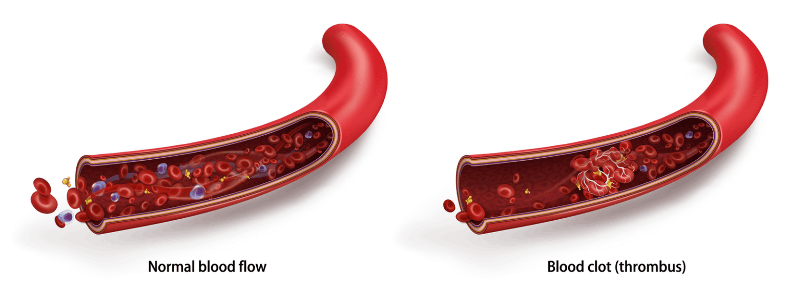 Get Screened for Blood Clots in Fairbanks, Alaska - Fairbanks Ultrasound