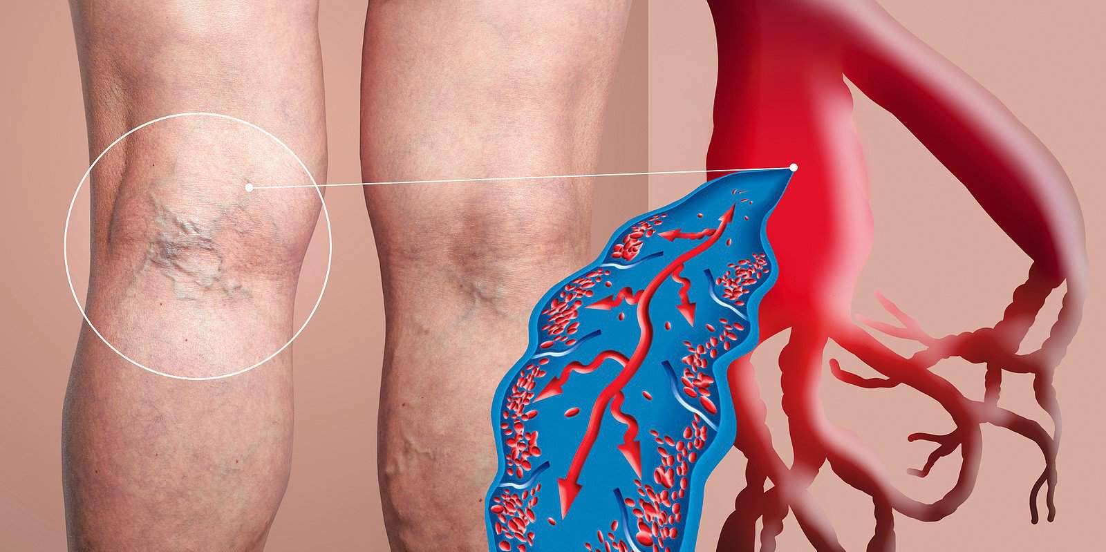 Get Screened for Blood Clots in Fairbanks, Alaska - Fairbanks Ultrasound