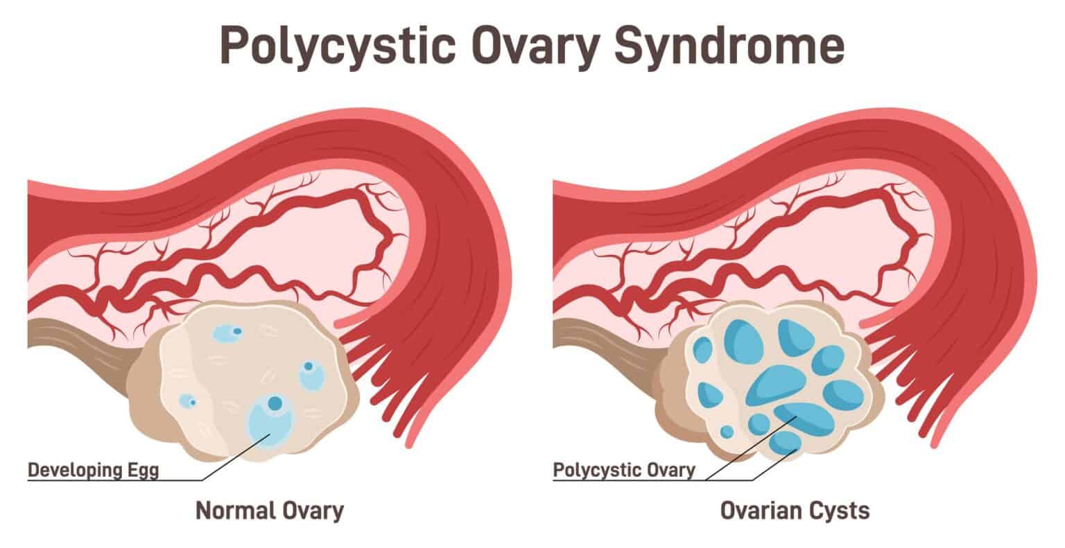 PCOS Ovary Ultrasound vs Normal - Fairbanks Ultrasound